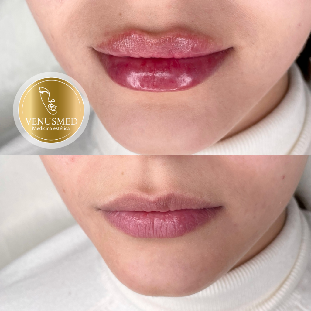Russian Lips - Clínica estética en Madrid - VENUSMED