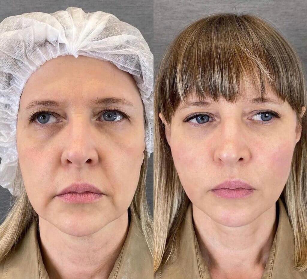 Estimulador de colágeno inyectable en Madrid y Barcelona