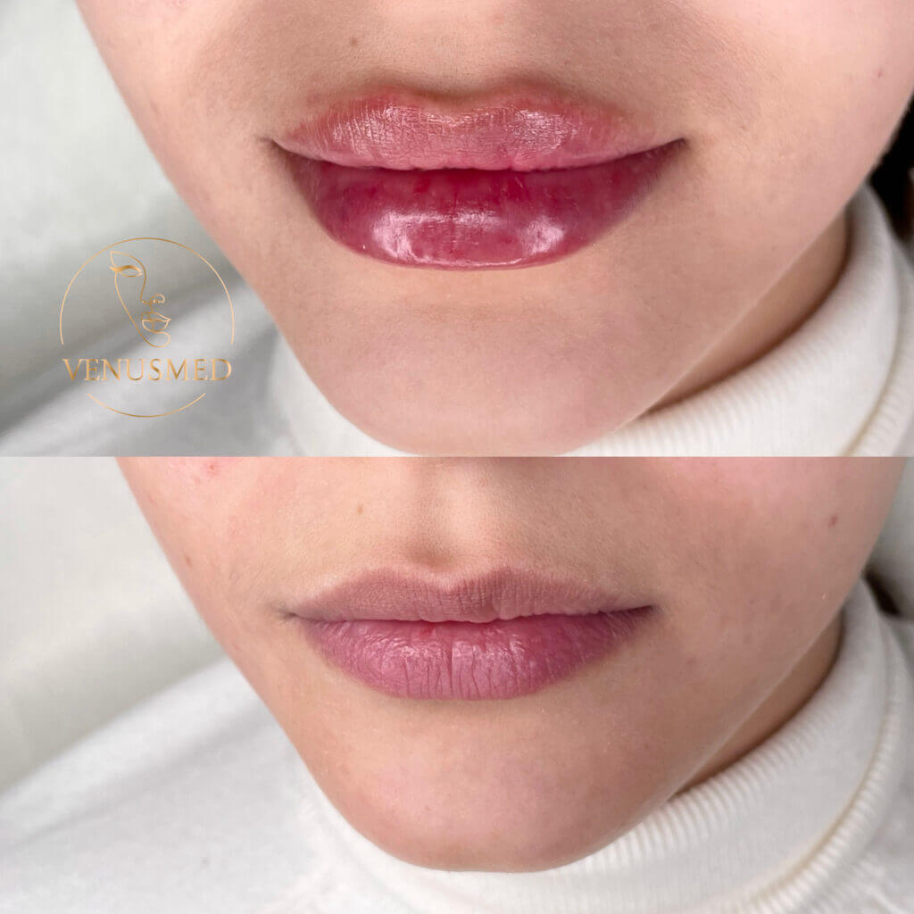 Aumento de labios Madrid y Barcelona | Labios naturales